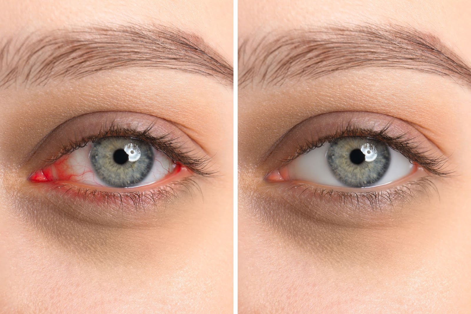 How to Tell if You Have Pink Eye or a Stye | Grundy